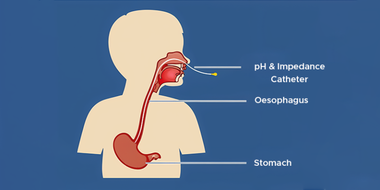 Esophageal Manometry and 24-Hour pH Impedance: Key Strategies for GERD ...