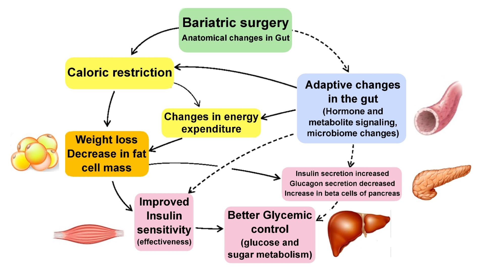 Surgery for Diabetes/Metabolic surgery: Can Diabetes be cured?